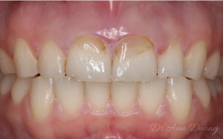 Dental Bonding - Before and After at Preventive Dentistry Braddon