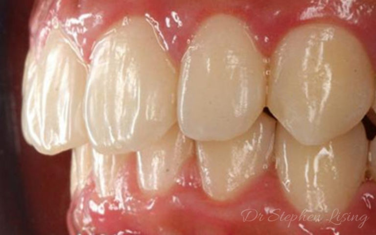 Invisalign Before and After - Case Studies by Preventive Dentistry, Braddon